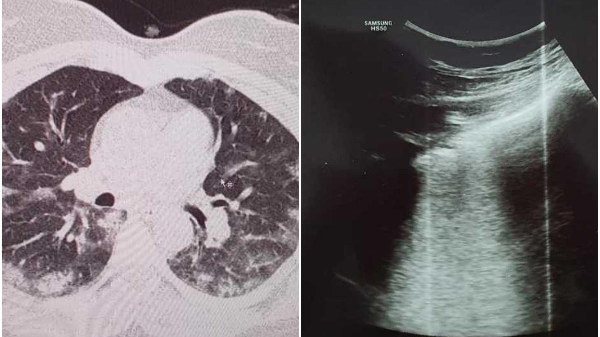 Avertismentul unui medic militar despre modul în care SARS-CoV-2 ...