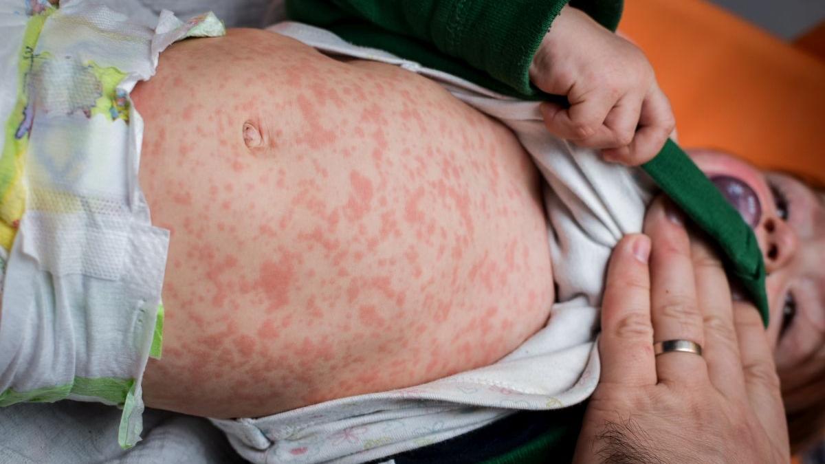 Focar de rujeolă la o şcoală din Bucureşti. Medic: "Jumătate din ...