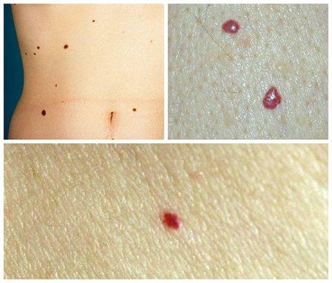 Ai aceste puncte roșii pe mai multe părți ale corpului? Uite ce trebuie ...