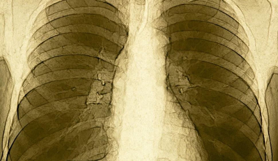 Medicii au descoperit un prezervativ în plămânii unei tinere. Cazul ...